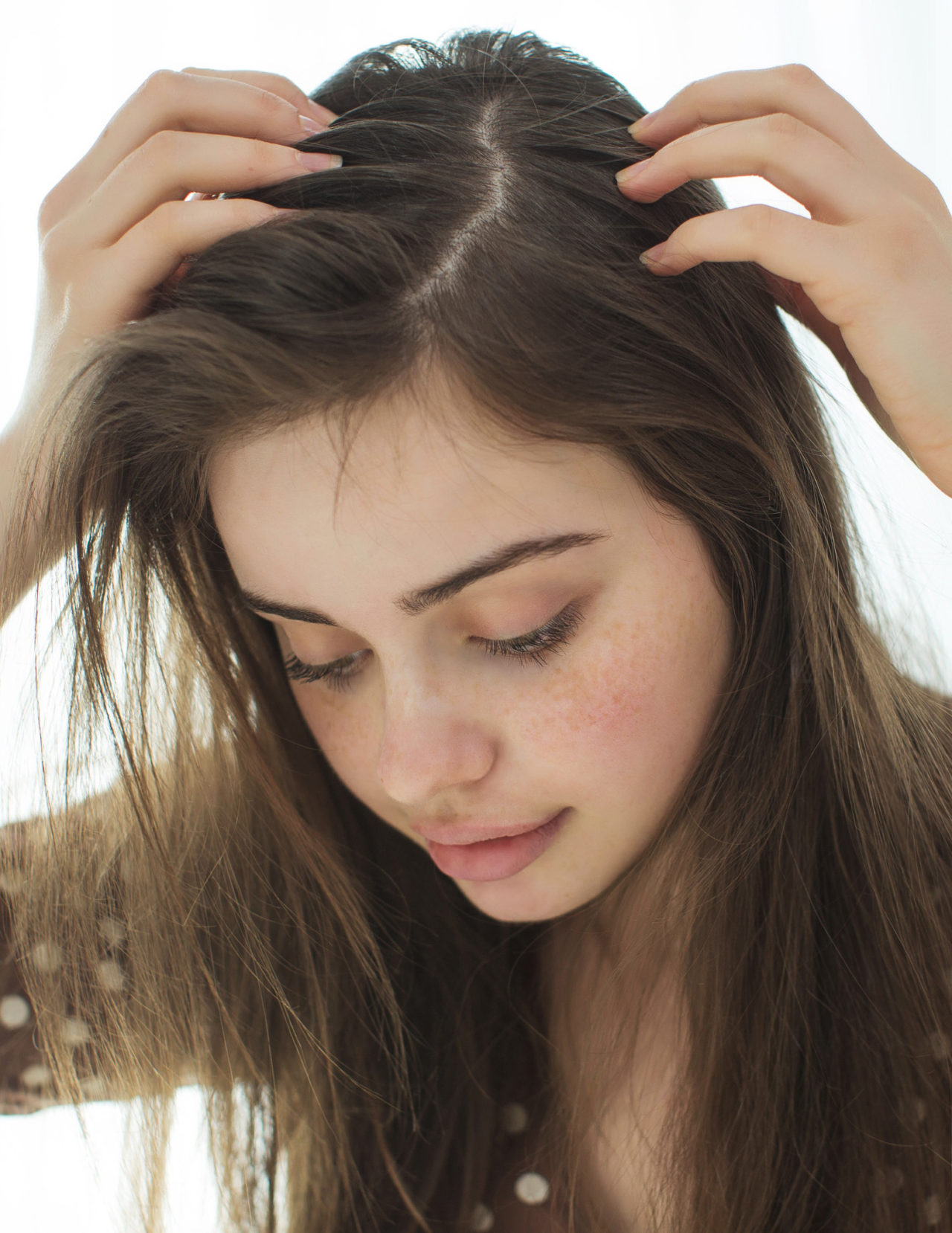Seborrheic Dermatitis Treatment | Boise Dermatologist